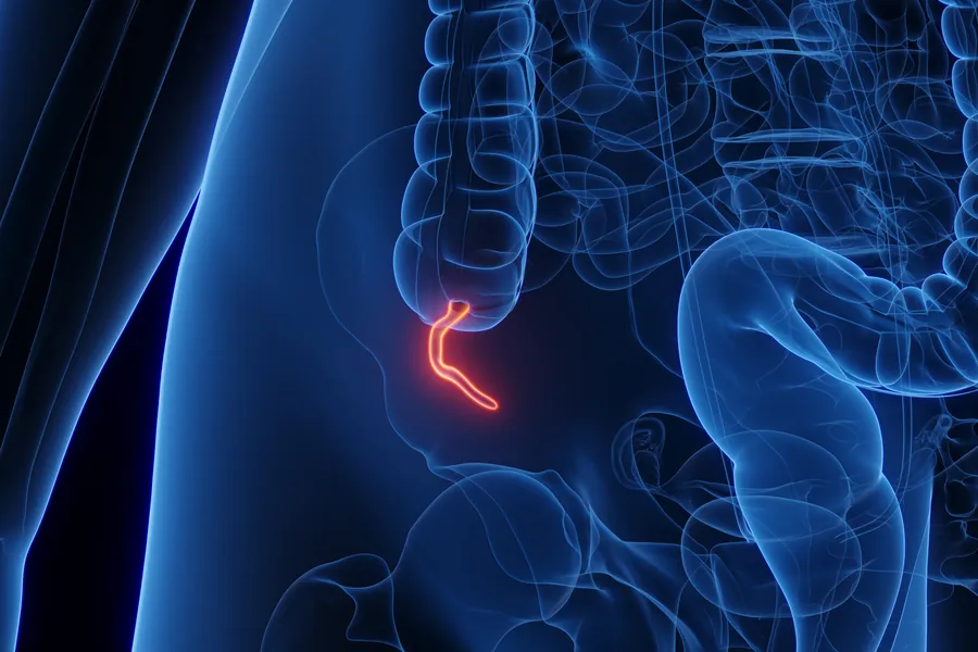 Appendix removal raises Alzheimer’s risk, but dietary shifts may ...